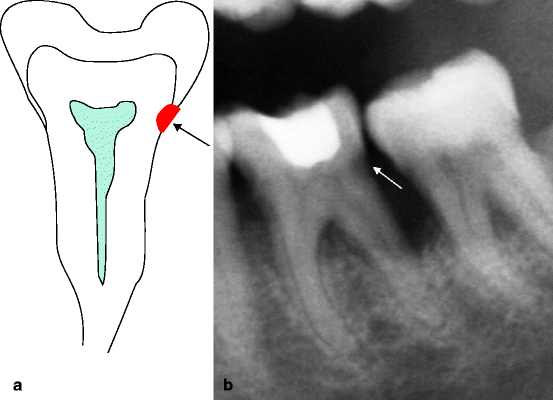 Tooth decay detection and classification Computer Vision Dataset by ...