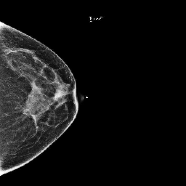 Breast Tumor Detection Object Detection Dataset By Project