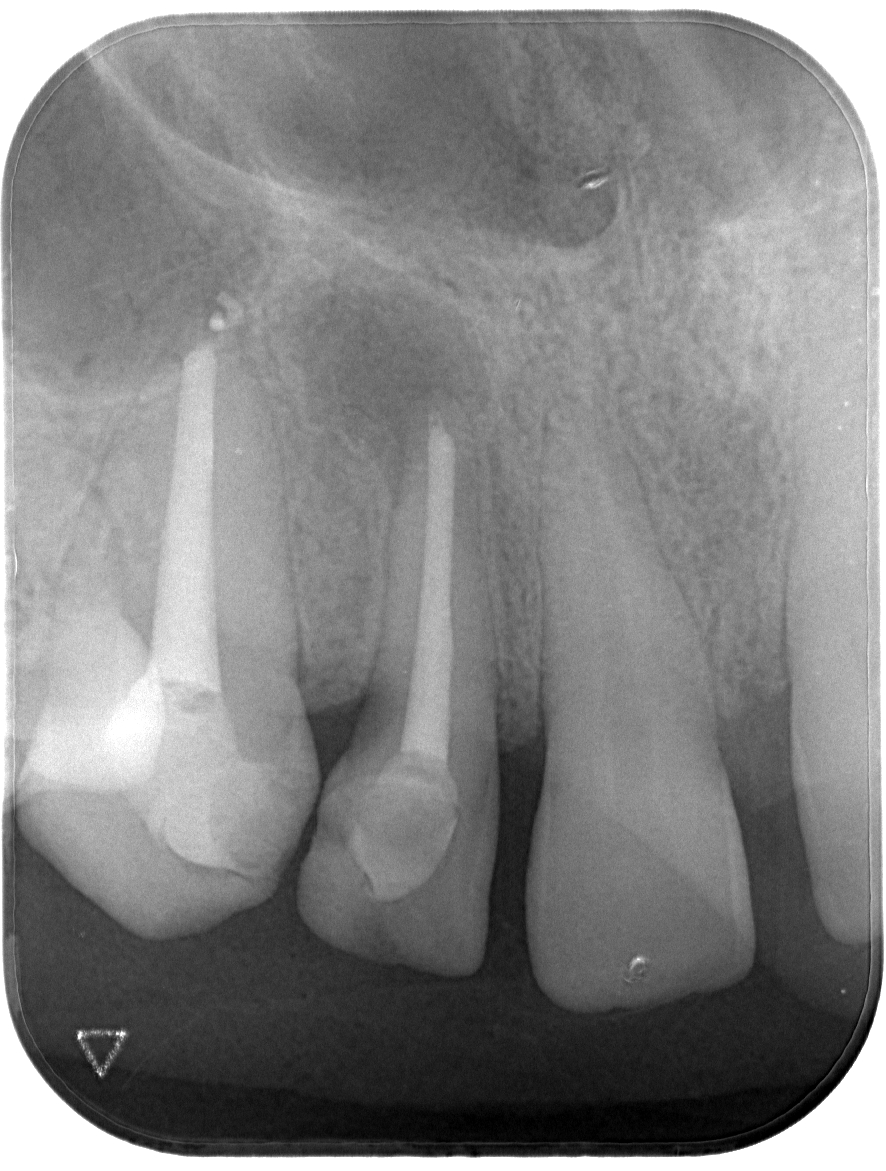 periapical_ust_aug_test Object Detection Dataset by cranioo