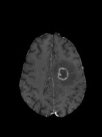 axial MRI Object Detection Model by Roboflow 100