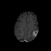 axial MRI Object Detection Model by Roboflow 100