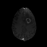 axial MRI Object Detection Model by Roboflow 100