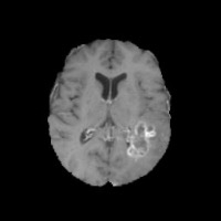 axial MRI Object Detection Model by Roboflow 100