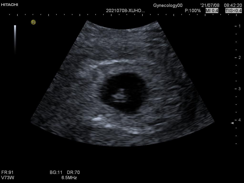gynecology MRI Object Detection Dataset and Pre-Trained Model by ... gynecology MRI Object Detection Dataset and Pre-Trained Model by ...