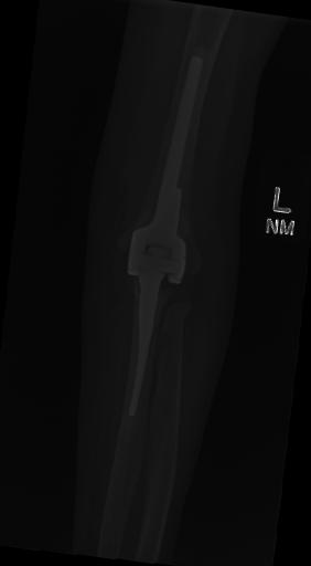 bone fracture Object Detection Dataset by bone fracture