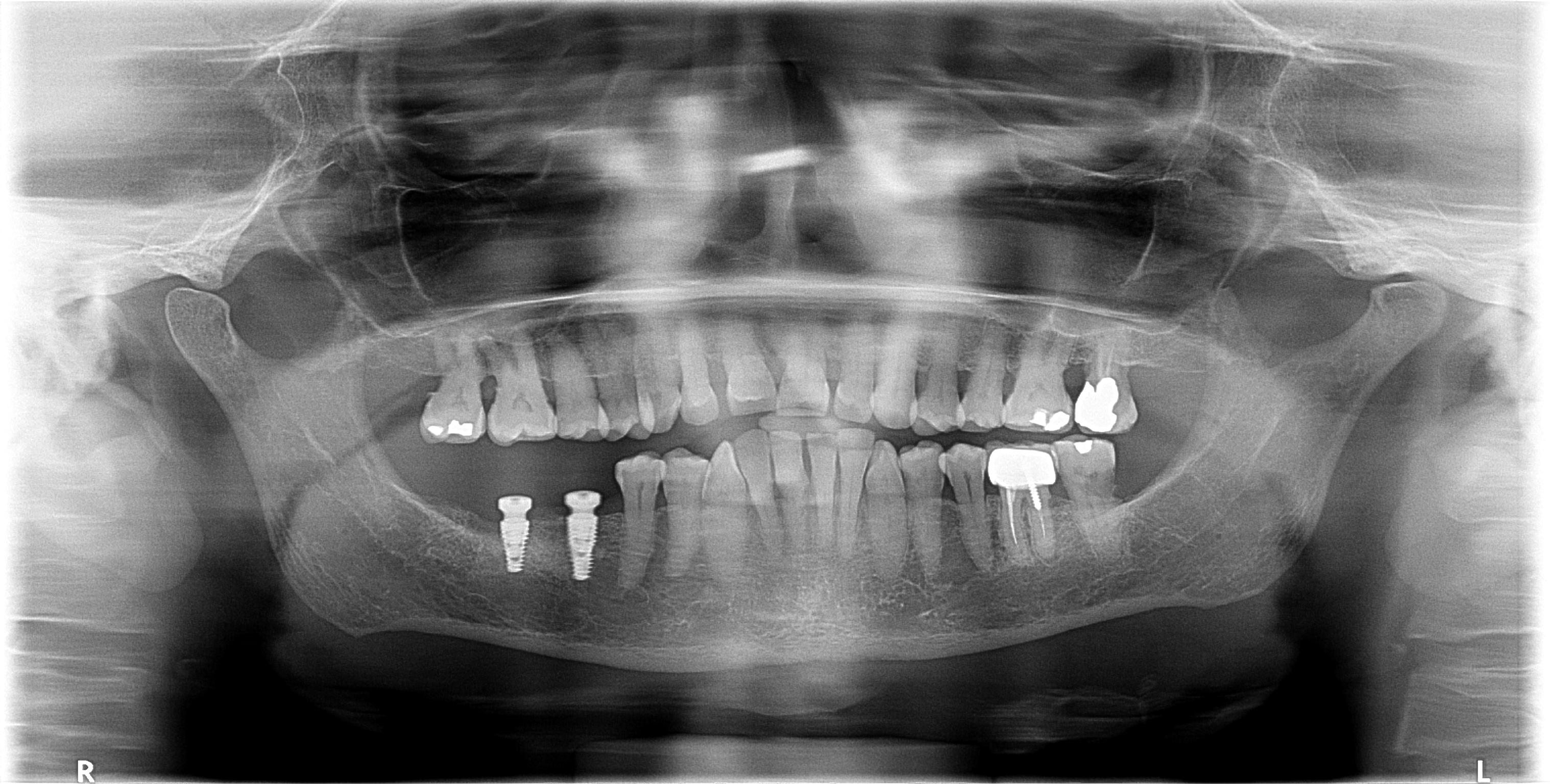 Teeth Numbering Each Object Detection Dataset By Ksmire