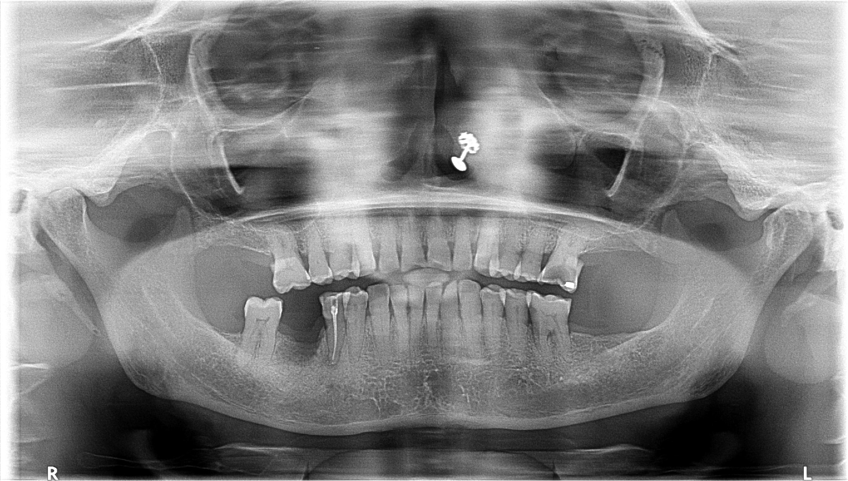 Teeth_numbering Object Detection Model by KSMIRE