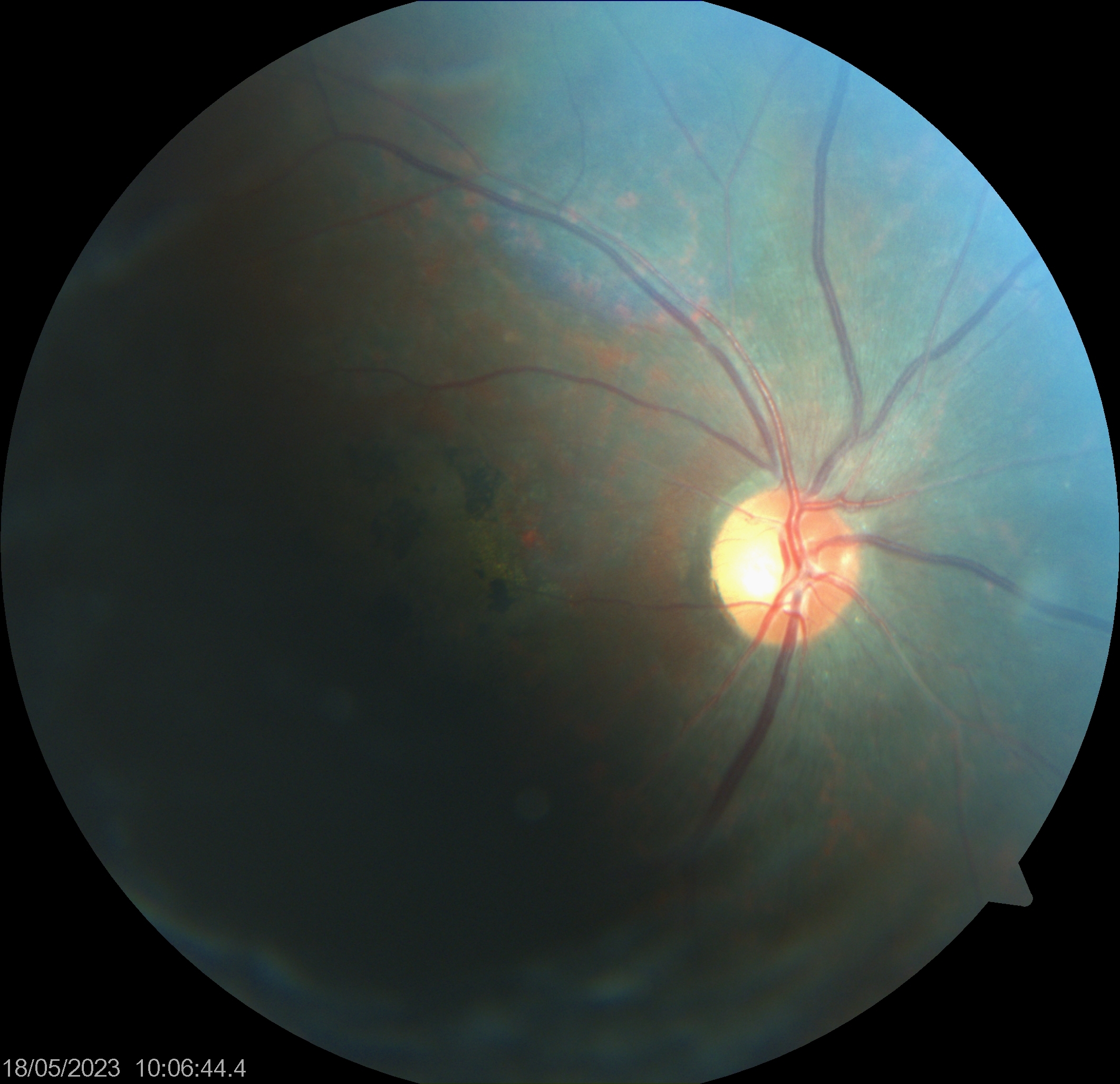 How to Use the eye-glaucoma Classification API