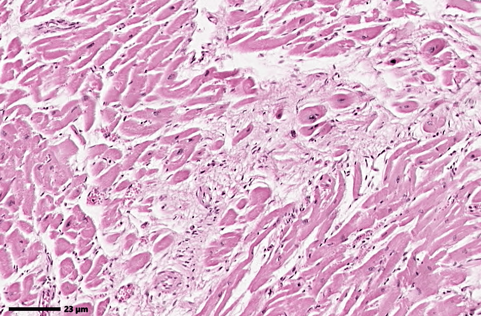 heart fibrosis Instance Segmentation Dataset and Pre-Trained Model by proiect