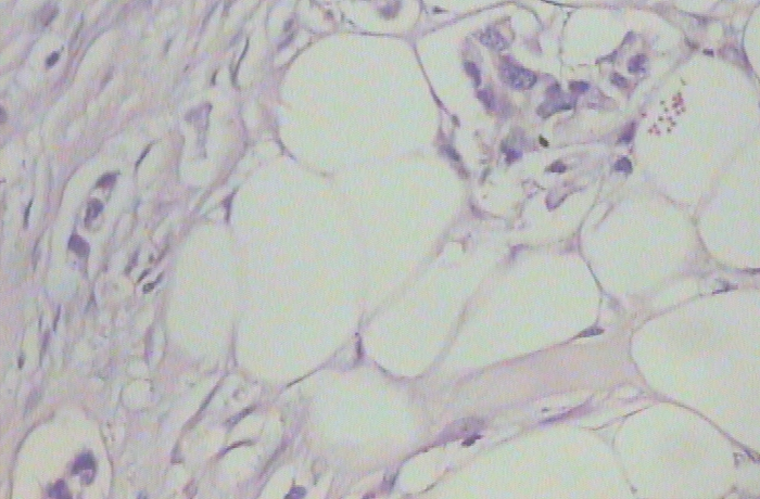 cancer Object Detection Model (v1, 2025-08-26 8:58am) by seas