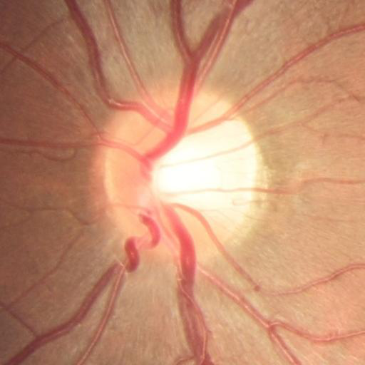 Glaucoma Project Classification Classification Model by Carina