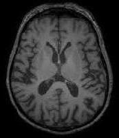 Brain Tumor Detection Object Detection Dataset by Machine Learning