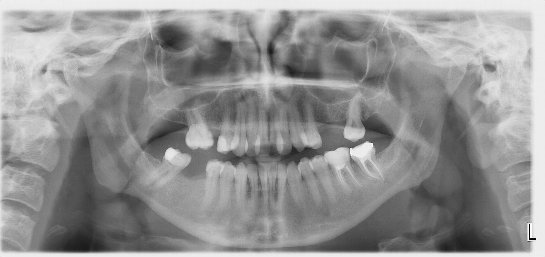 Tooth Detection Object Detection Dataset and Pre-Trained Model by Endodontic AI