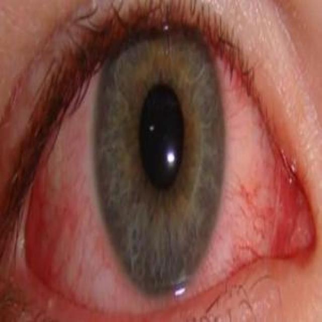 Eye Health Object Detection Dataset By Yohanes Nuwara