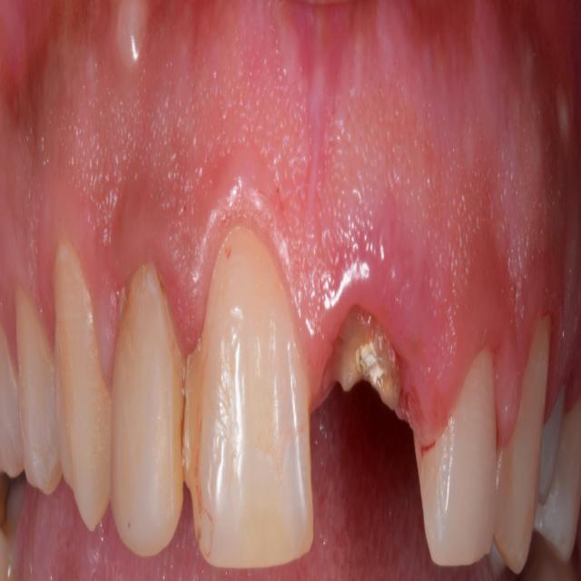 Teeth Health Object Detection Dataset By Yohanes Nuwara