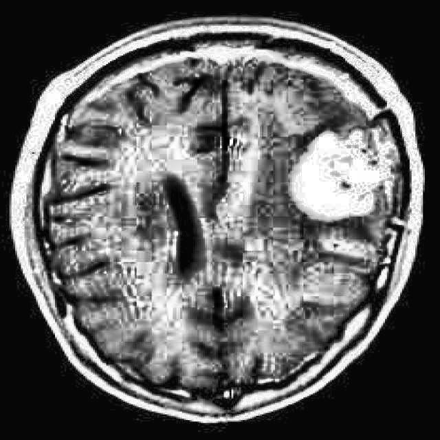 Mri Tumor Detection Semantic Segmentation Dataset By Yohanes Nuwara