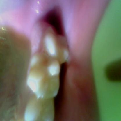 Intra-oral Project Object Detection Dataset by My Workspace