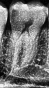 Dental Caries Classification Classification Dataset by seungChan