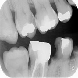 Caries Detection Object Detection Dataset by seungChan