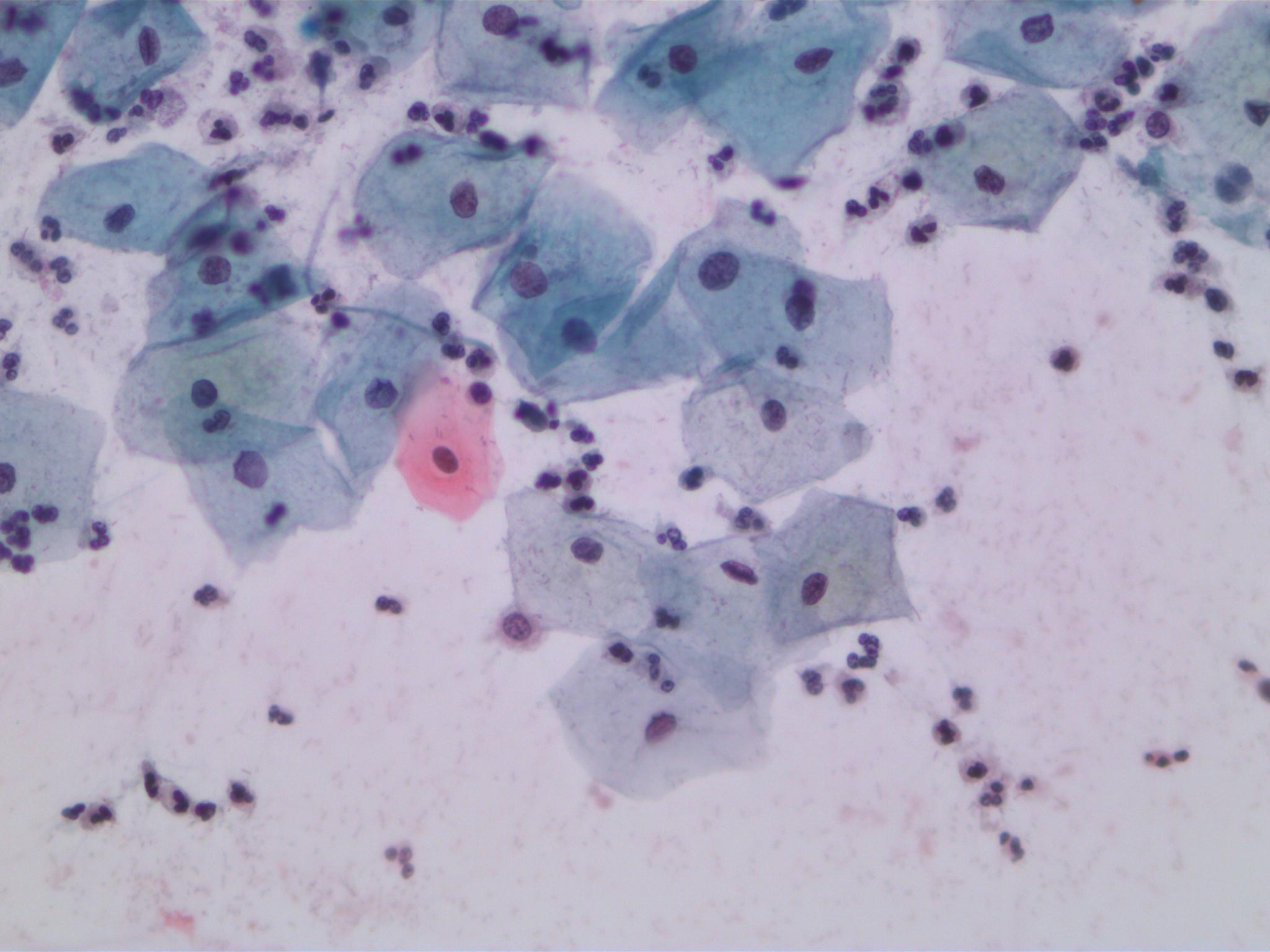 cervical-cancer Object Detection Dataset by Cancer