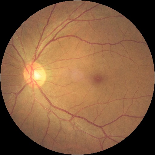 Cataract Classification Dataset by Dark Lord