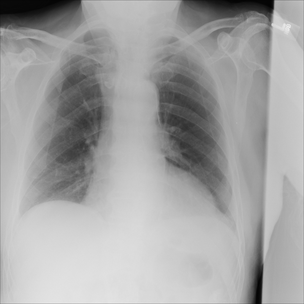 Pneumonia Object Detection Dataset And Pre Trained Model By Pneumoniachatbot