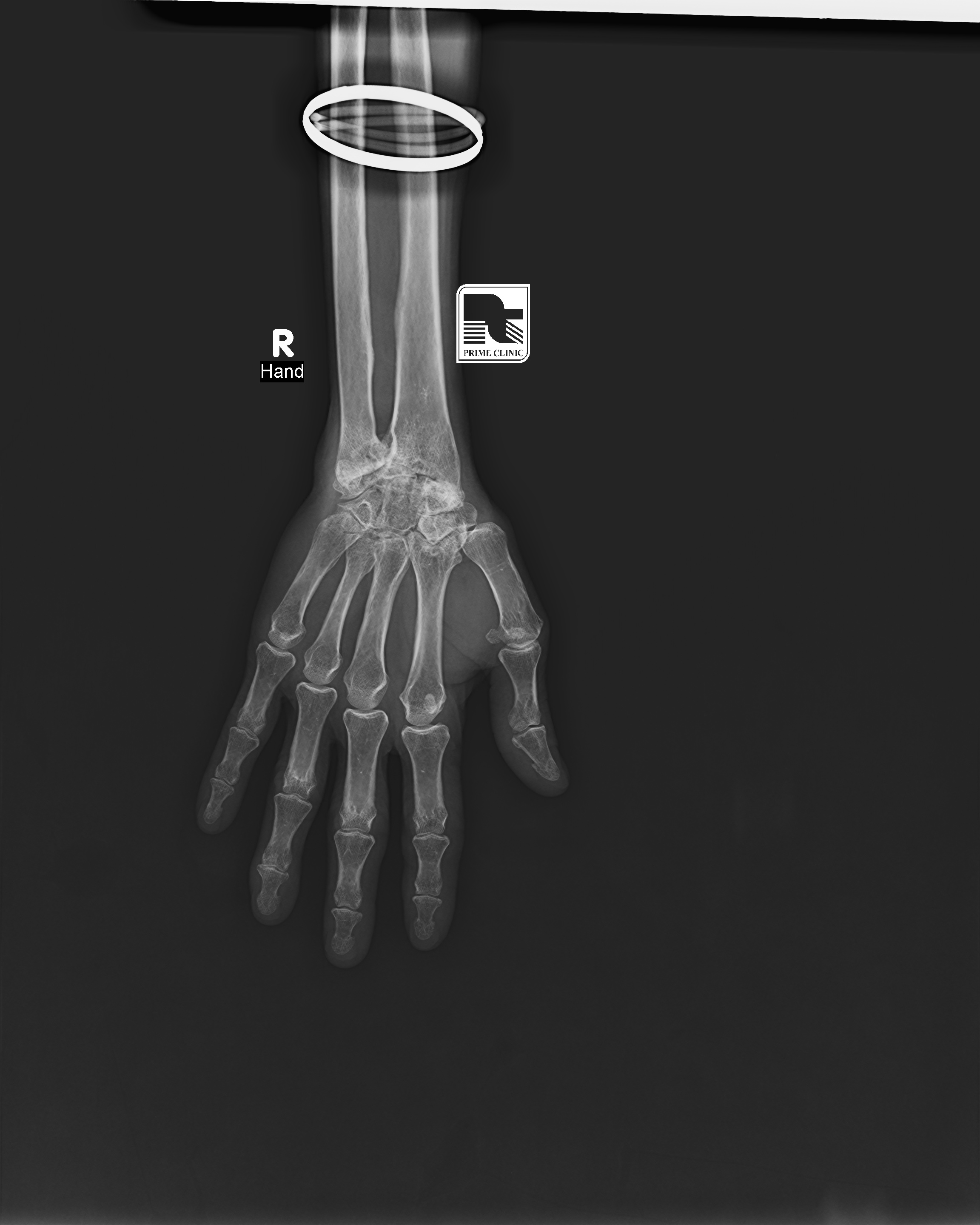 Bone fracture Object Detection Dataset by ultra