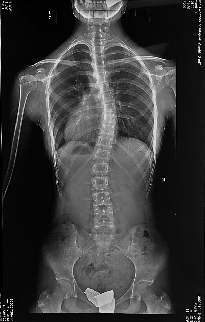 Spine_FYPII Instance Segmentation Dataset and Pre-Trained Model by Spine