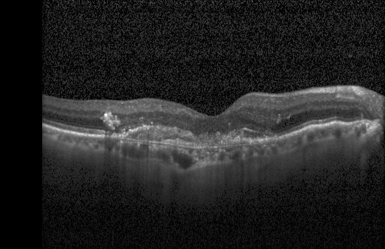 retinal-detachment--retina-detachment Object Detection Model by project