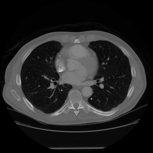 Lung Nodule Detection Object Detection Dataset And Pre Trained Model By