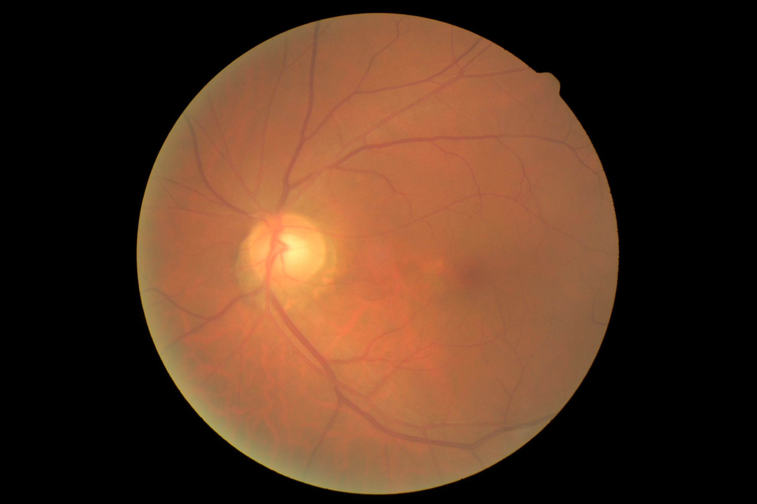 Detección cataratas Classification Model by Cataracts