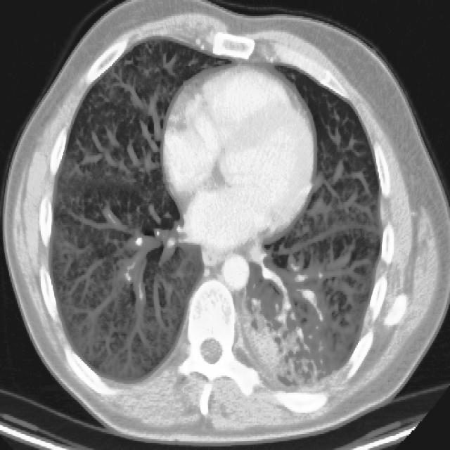 Lung Cancer Object Detection Dataset By Chudamani