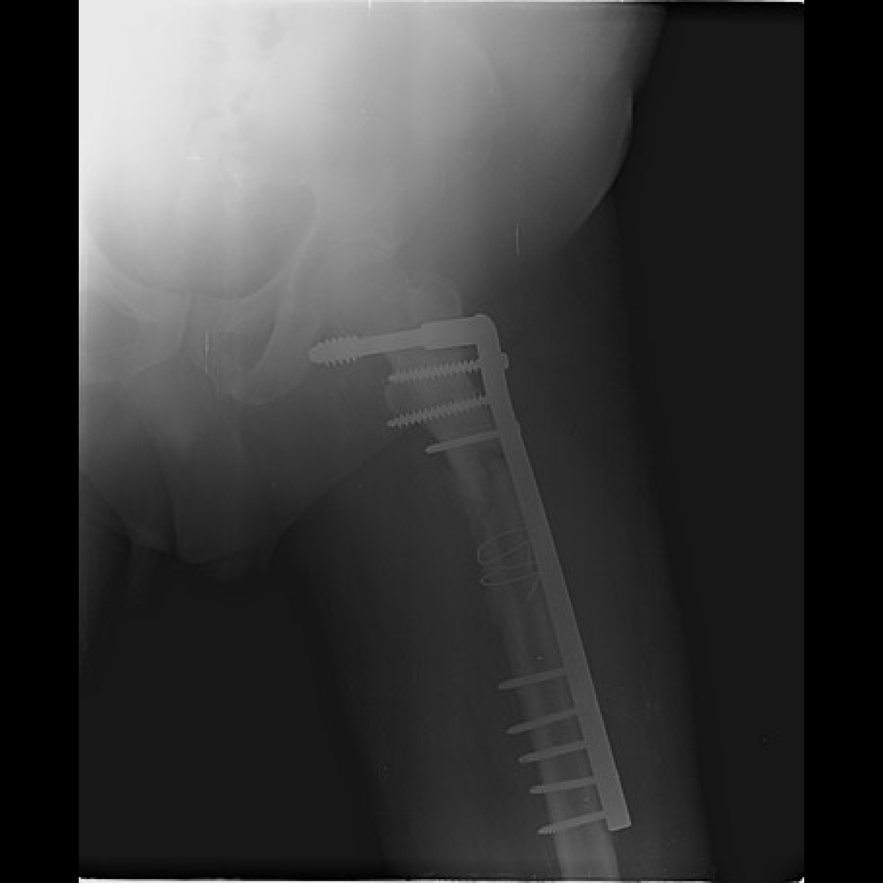 Kırık Tespit Uyguslsmdı Object Detection Dataset By Proje