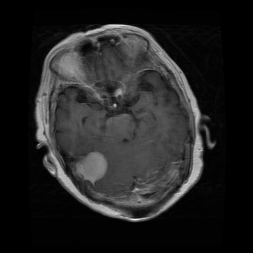 Brain Tumor Detection Brain Tumor Detection Bwhdo Roboflow Universe