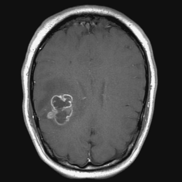 Br35H Object Detection Model by PFE