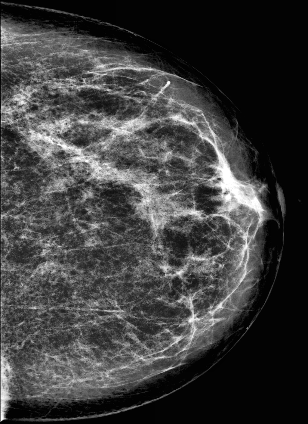Inbreast_normal Object Detection Dataset by Zakir Alam