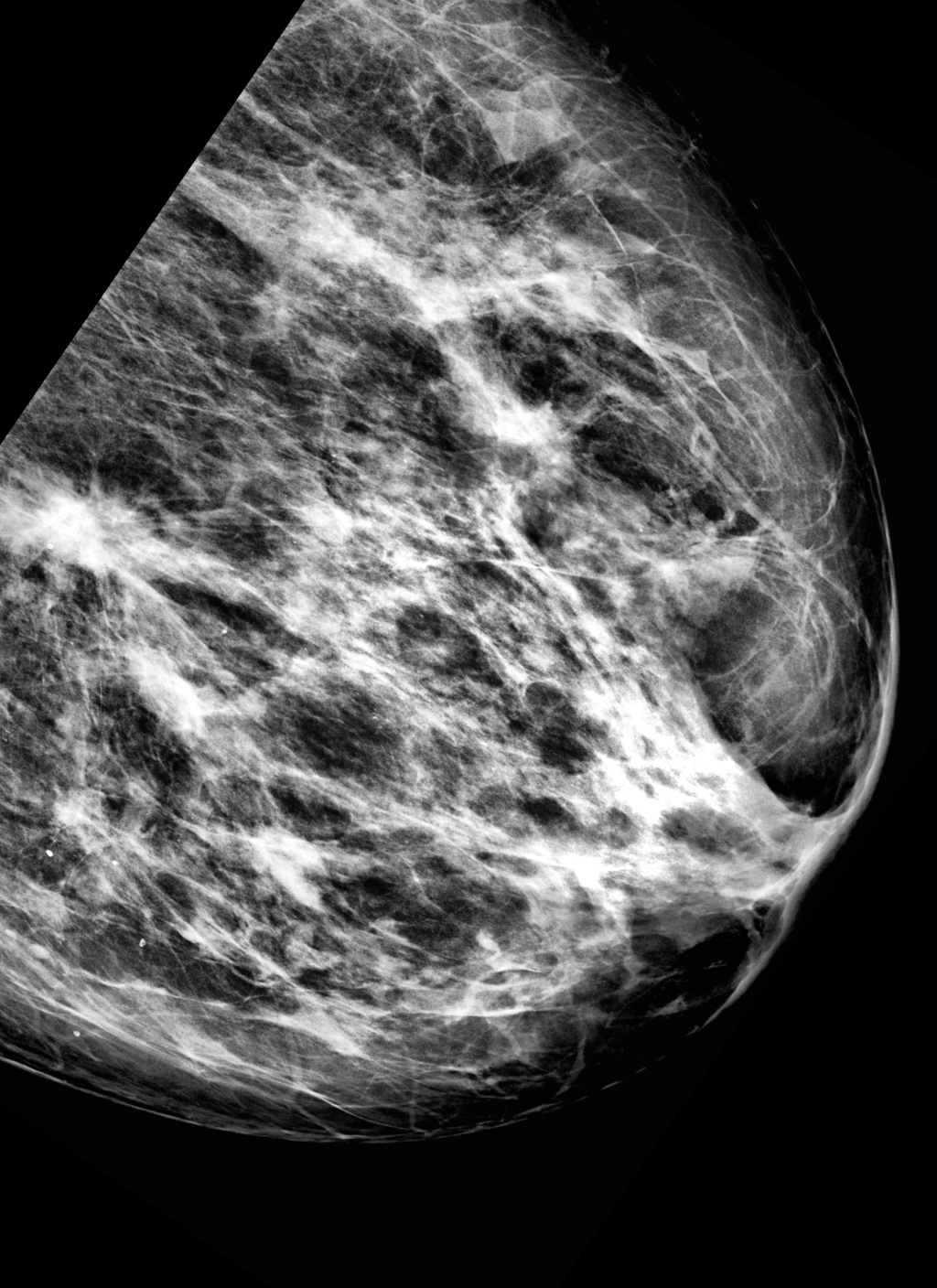 inbreast-class Object Detection Dataset by Zakir Alam