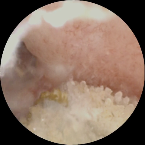 kidney stone,fiber,tissue Instance Segmentation Dataset by Ilk