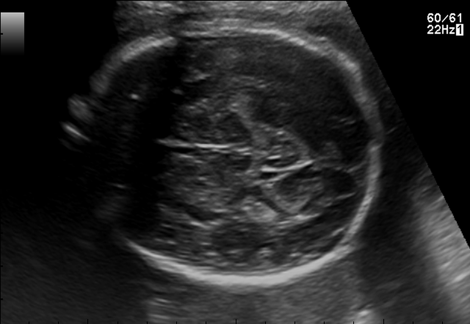 Fetal Brain Ultrasound Object Detection Model V2 2024 08 17 8 54am