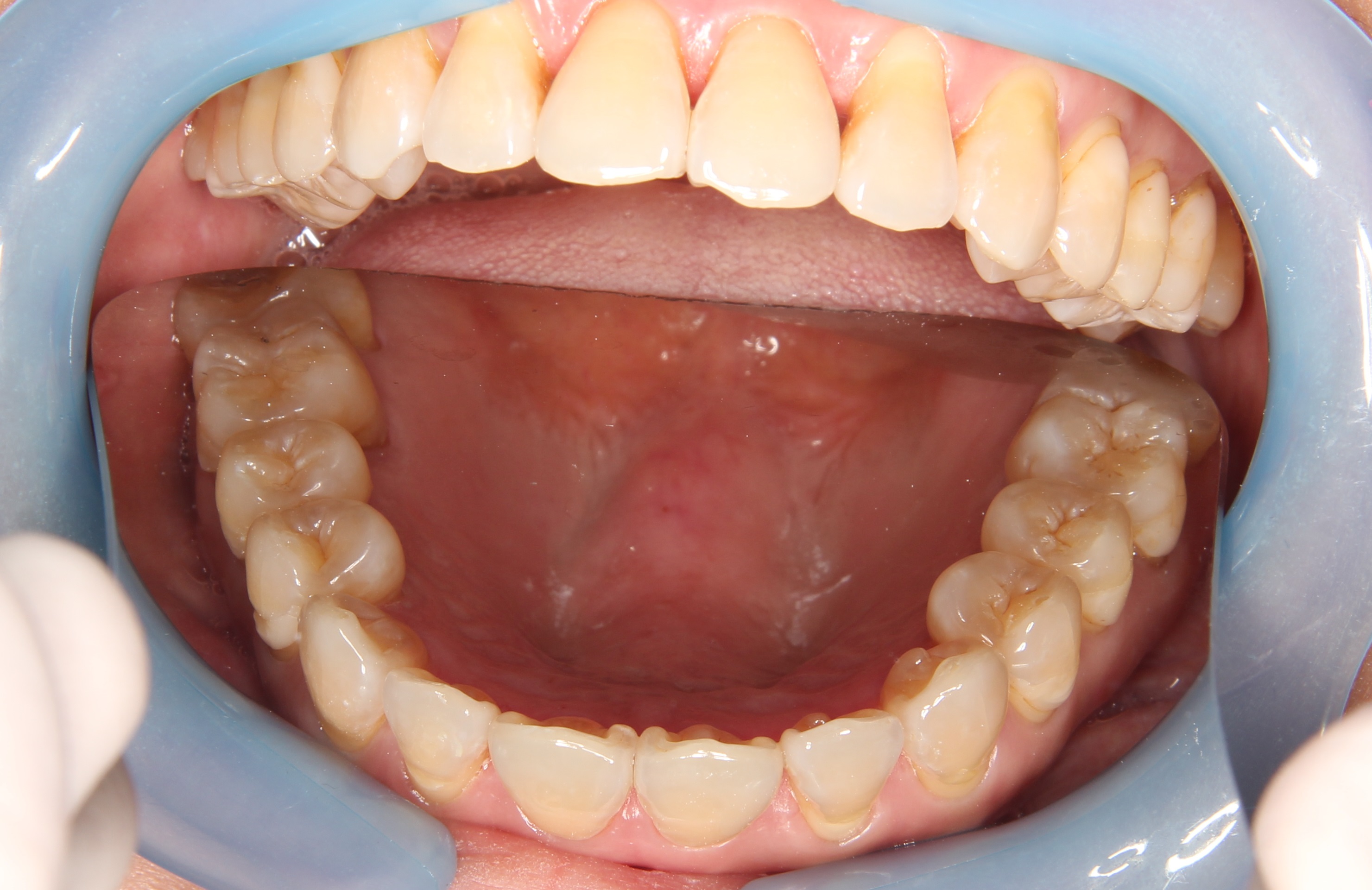 Upper Intraoral Tooth Numbering Object Detection Dataset And Pre