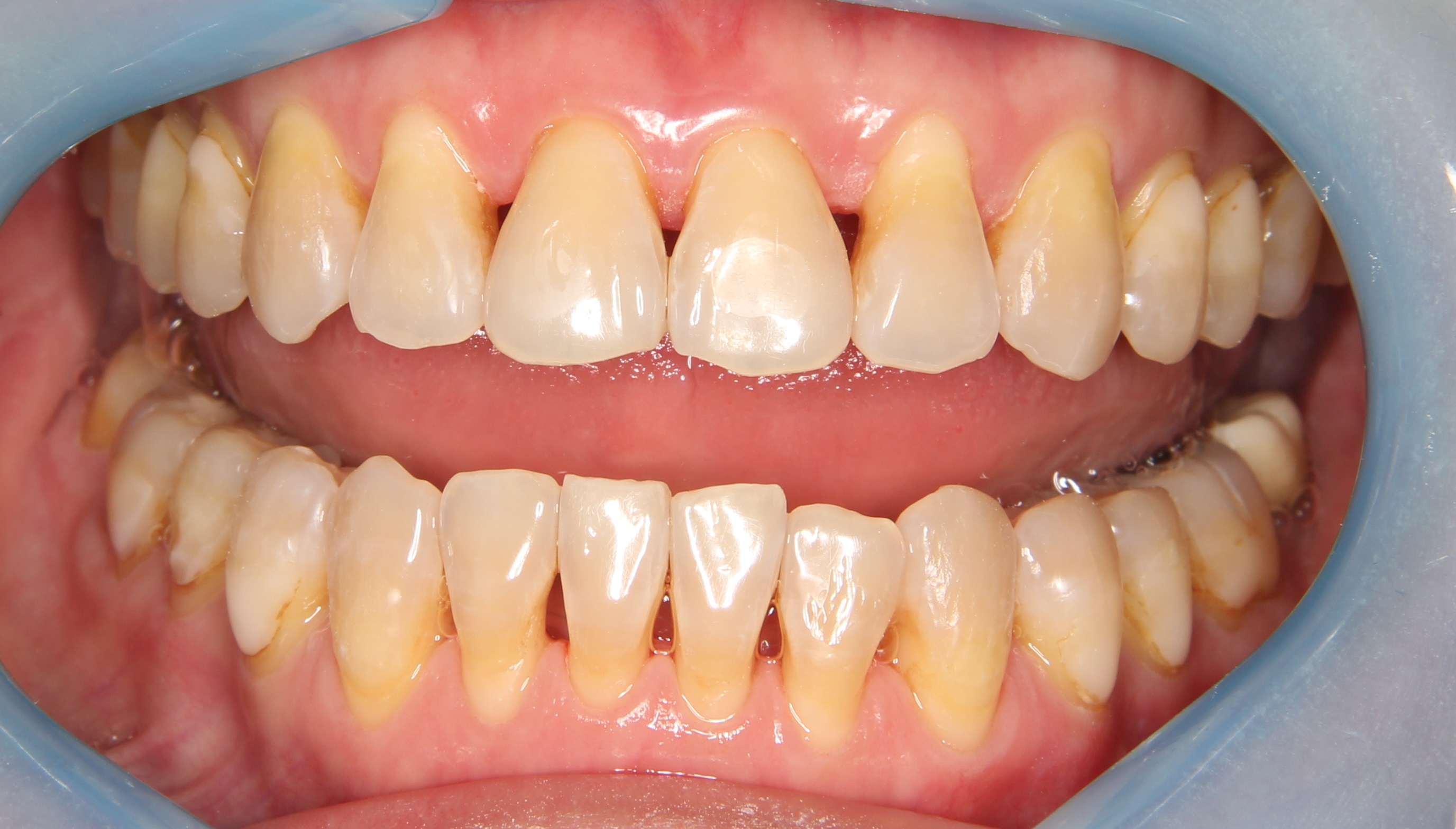 Front Intraoral Tooth Numbering Object Detection Model By Dentalmate6v