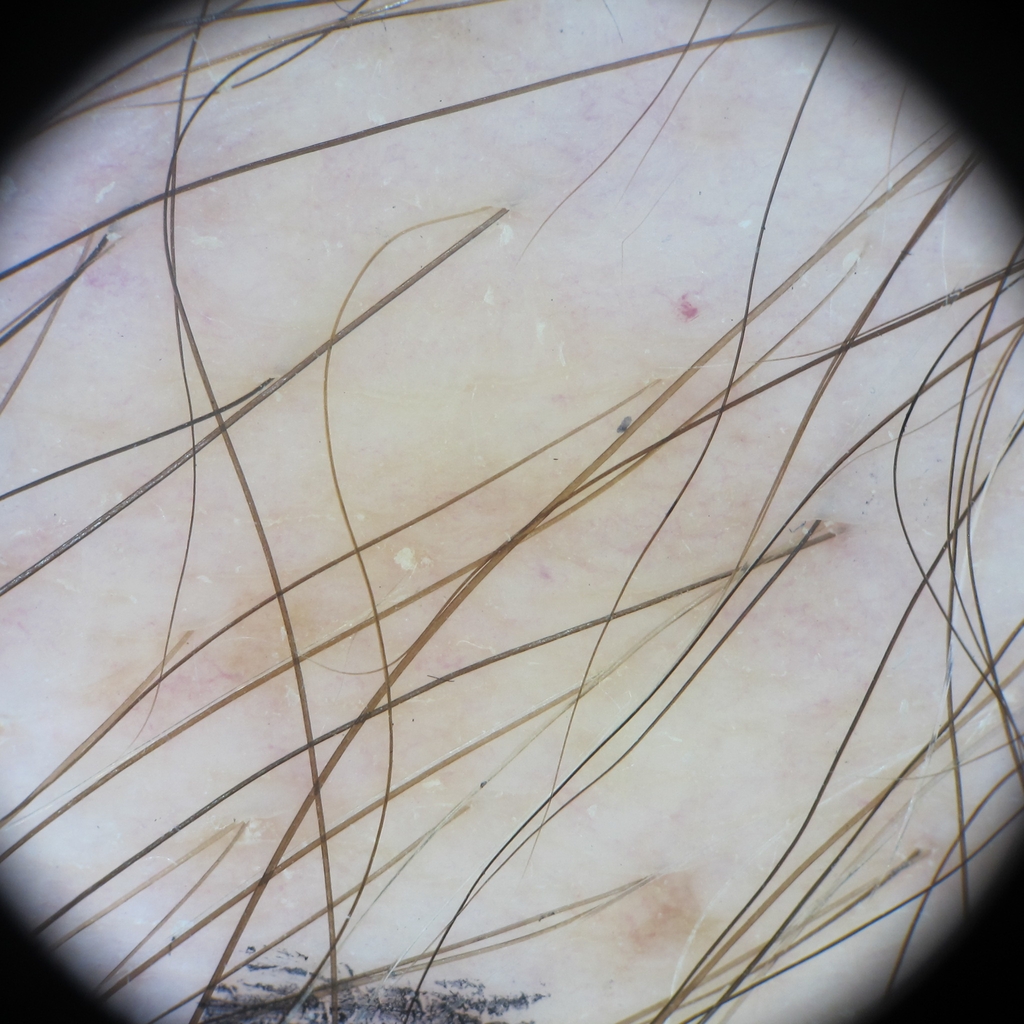 Skin Cancer Detection Object Detection Dataset And Pre Trained Model By