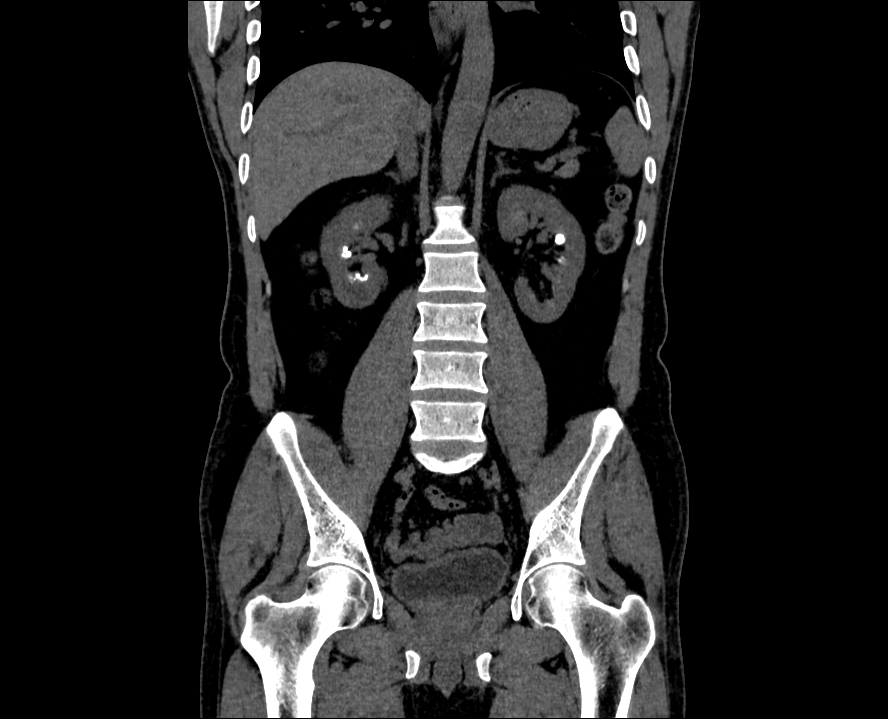 CT detection at kidney level Classification Model by University