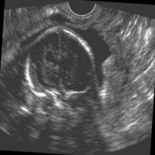 Semantic Segmentation On Fetal Brain Semantic Segmentation Dataset By Cv