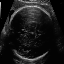 Fetal brain instance segmentation Instance Segmentation Dataset and Pre-Trained Model by CV