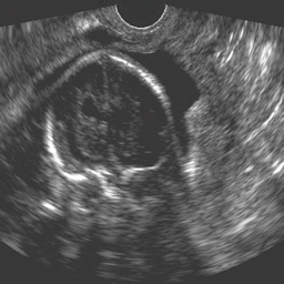 Instance segmentation on abnormal fetal brain Instance Segmentation Dataset by CV