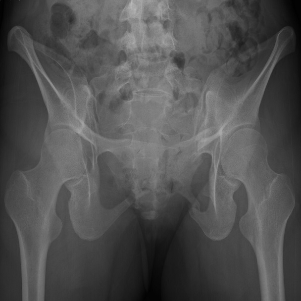 fracture Object Detection Dataset and Pre-Trained Model by michellepelvic