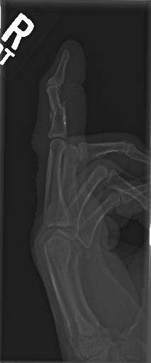 bone fracture Object Detection Dataset by Dhruti