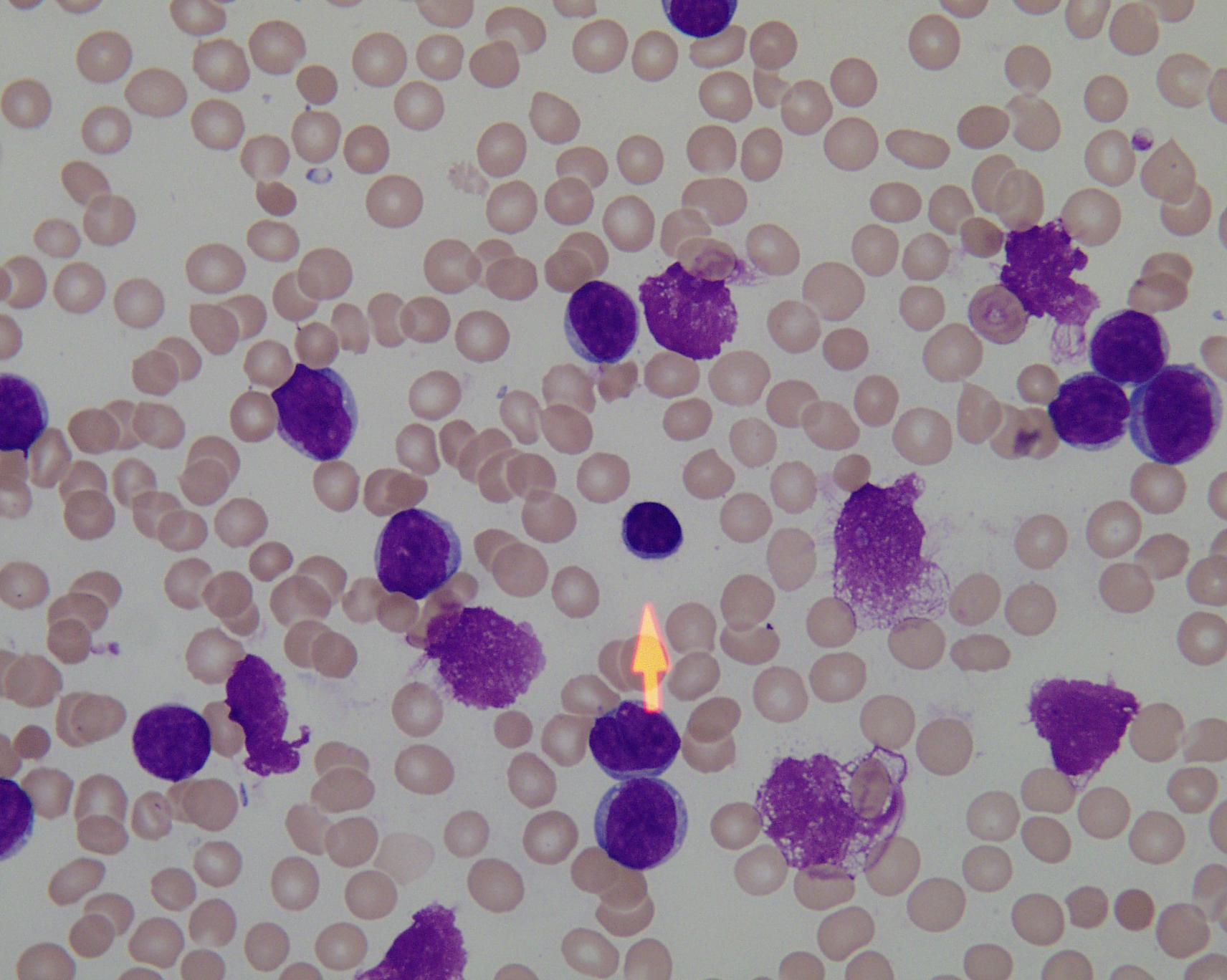 Leukemia Object Detection Dataset By Proper Thick Ai