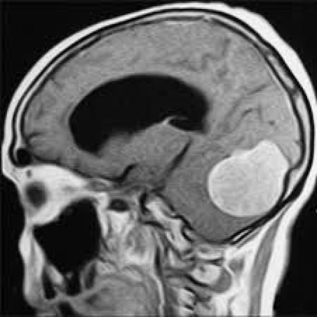 Semantic Segmentation Object Detection Dataset And Pre Trained Model By Bone Fracture